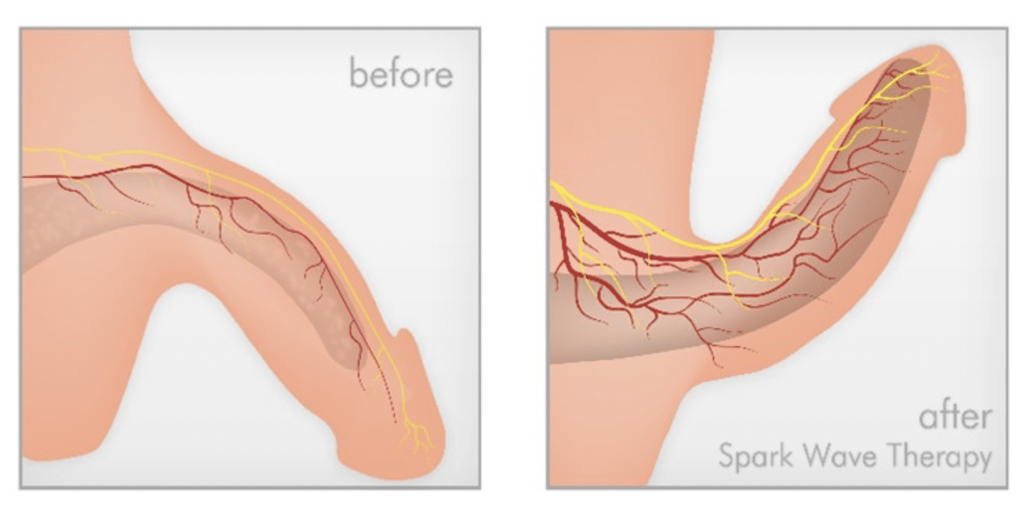 Shockwave Therapy for ED - Chill Cryotherapy Marlboro